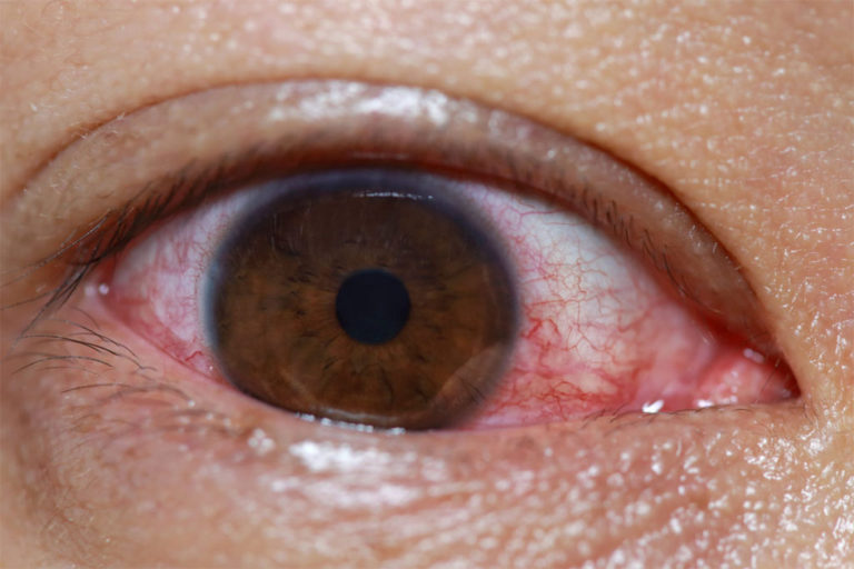 Eye Infections - Innovision Family Eye Care Tx.